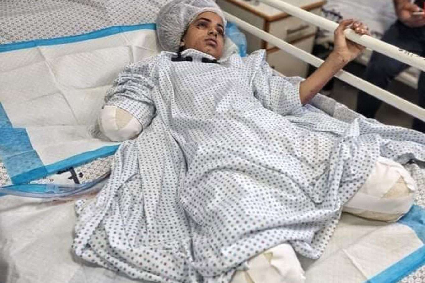 Rahaf, child amputee, needs medical treatment in Turkiye - [İLKHA] Ilke ...